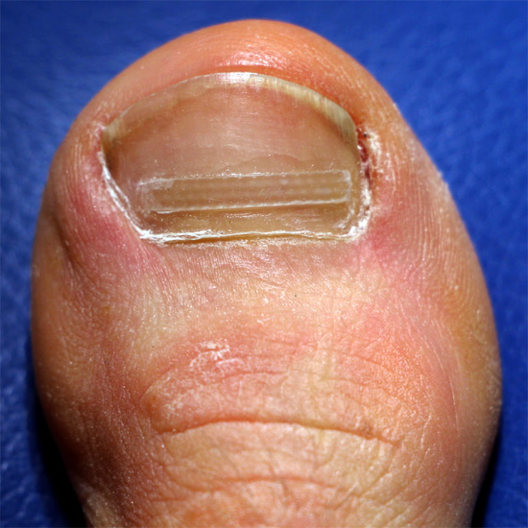 Orthoplasties/Orthonyxies - N. Bigache - Pédicure Podologue à Thonon